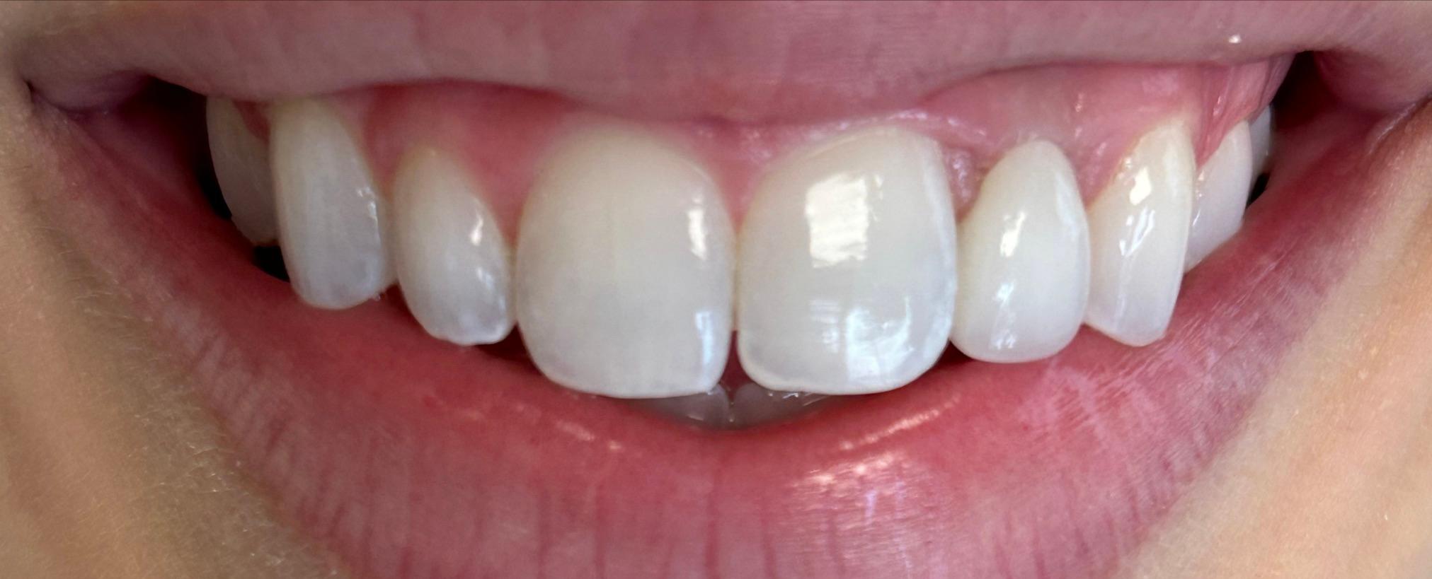 Before & After Dental Photos Rogers MN, Smile Gallery